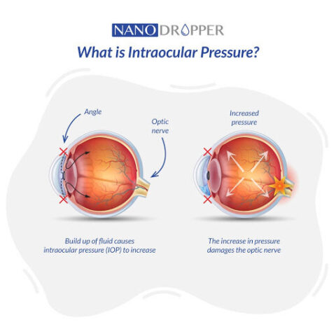 What is Intraocular Pressure (IOP)? - Nanodropper